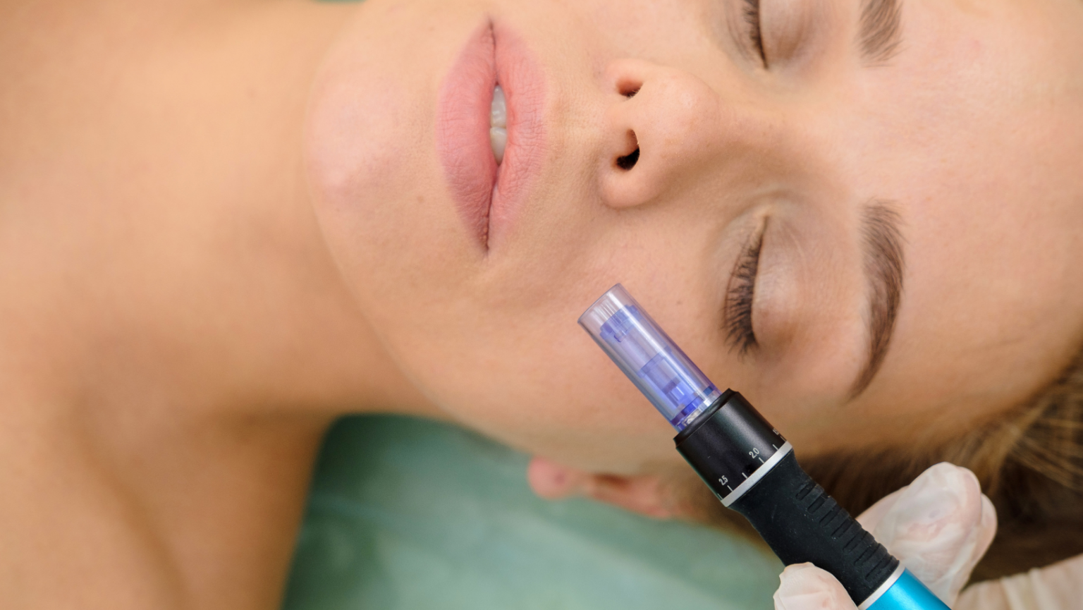 Top 3 Benefits of Microneedling with PRF - the IV health centre